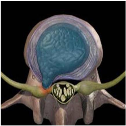 Pinched Nerve? Ruptured Disc? Get a Doctor quickly, get the right ...